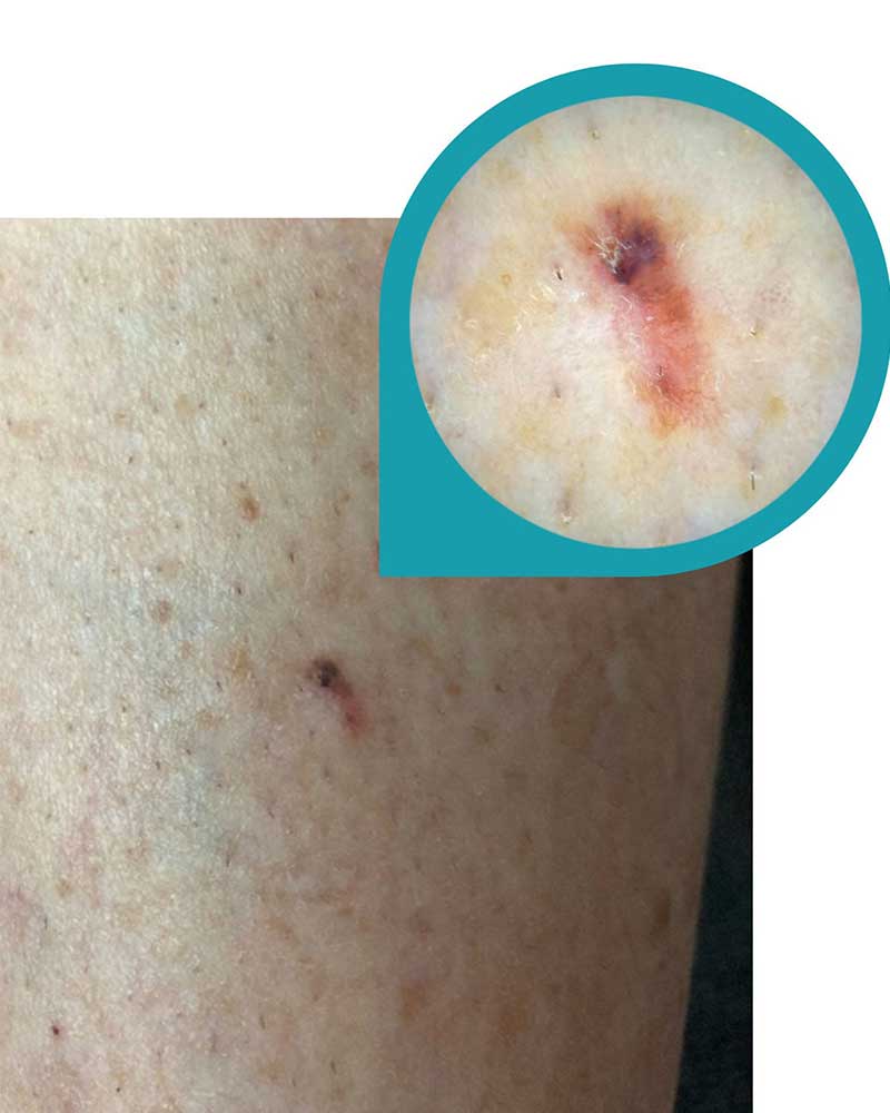 600 Nurses Project: Targeted skin checks led by primary care nurses in ...